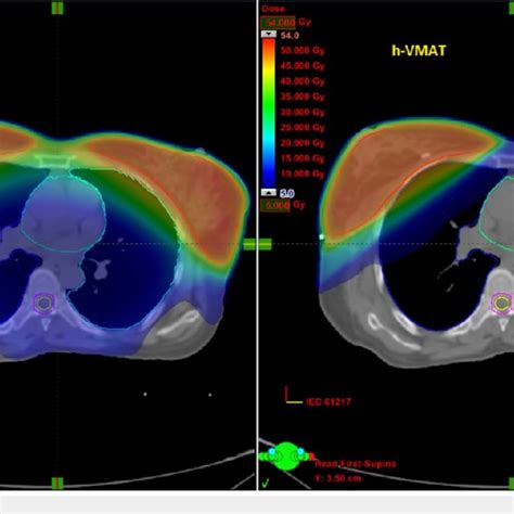 Gamma Analysis For H Vmat Portal Dosimetry Download Scientific Diagram