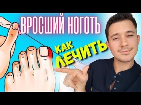 Ногти. Как лечить вросший ноготь. Коррекция вросшего ногтя. в 2024 г ...