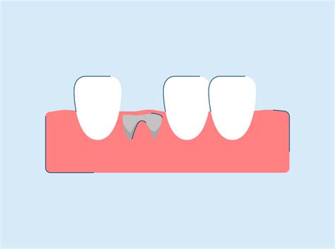 Dry Socket Vs Normal Socket After Tooth Extraction Snow® Oral Care