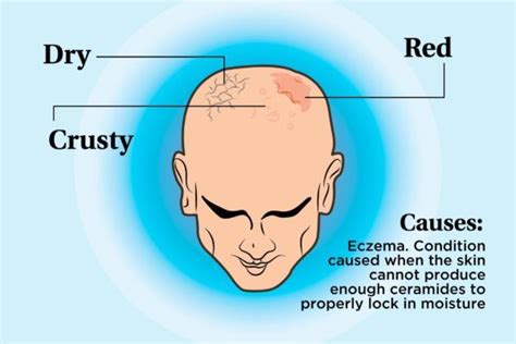Scalp Conditions You Definitely Dont Want To Ignore Readers Digest