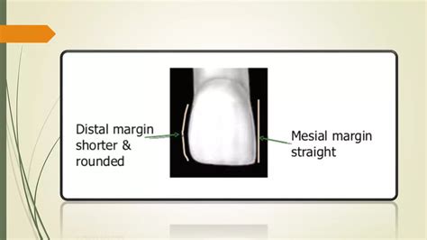 Maxillary Central Incisor Oral Anatomy Pptx