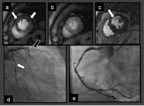 Patient With Previous Myocardial Infarction And Inducible Ischemia