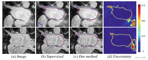 半监督3d医学图像分割（二）：ua Mtuamt模型 Csdn博客