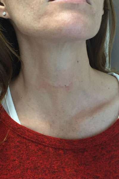 Thyroidectomy Scar Photos Thyroid Cancer Surgery Scars Endocrine