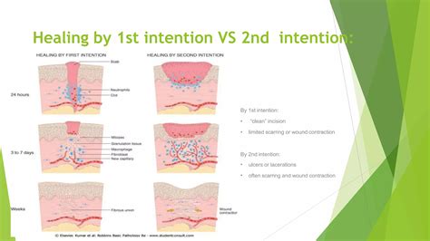 Acute And Chronic Inflammation And Wound Healing Pptx