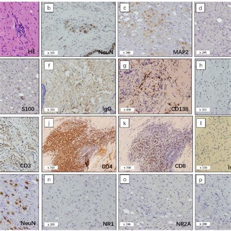 Pathology Findings Of Neural Tissues And Nmdar Staining In Teratomas