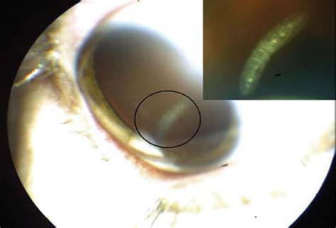 Myiasis Slideshow