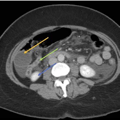 CT Axial View Showing The Appendix Green Arrow Inferior To The Download Scientific Diagram