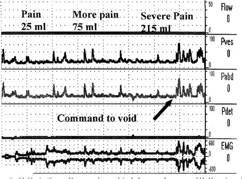 Figure 1 From Urodynamic Classification Of Patients With Symptoms Of Overactive Bladder