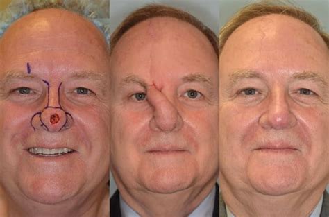 Paramedian Forehead Flap Before And After Utilization Of The