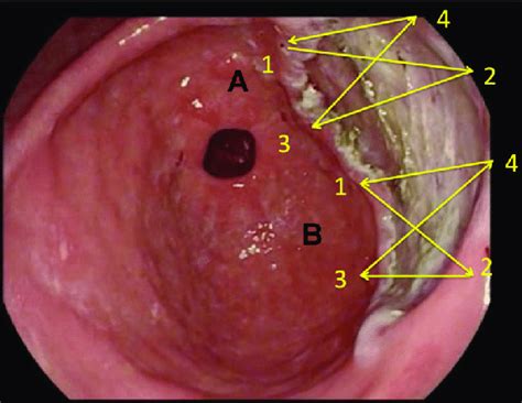 Pattern For Tissue Approximation Of A Large Circular Defect Download