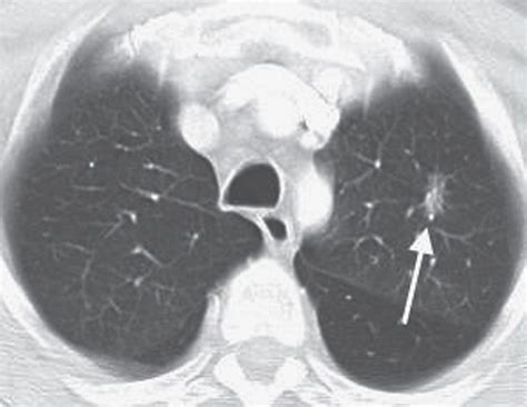 Solitary And Multiple Pulmonary Nodules Radiology Key