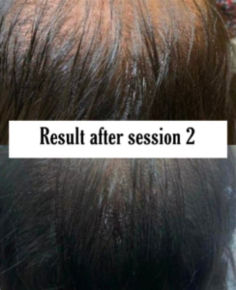 Scalp Micropigmentation Training Course In Singapore Smp Classes
