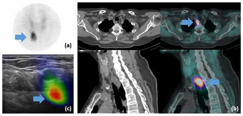 Feasibility And Performance Of Free Hand Single Photon Computed Tomographyultrasonography For