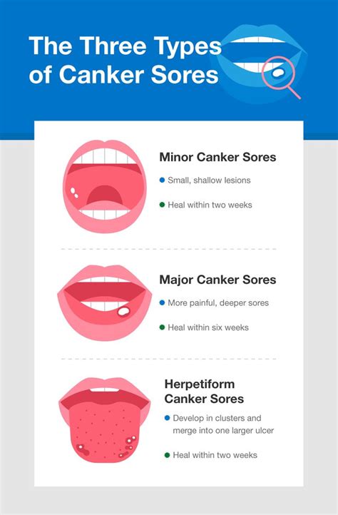 Canker Sore Causes Canker Sore Remedy Canker Sore Remedies Mouth Ulcers