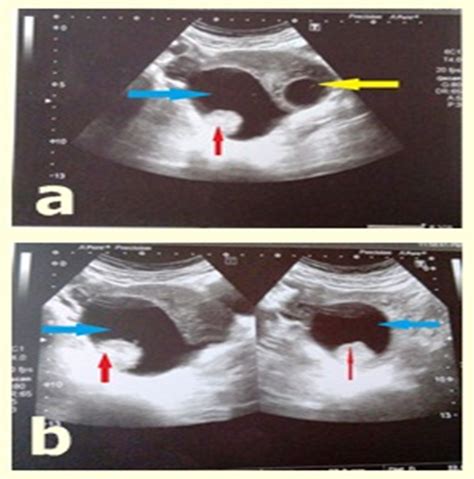 Icd 10 Code For Complex Left Ovarian Cyst