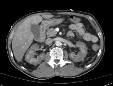 5 Cortical Infarct Ischemic Necrosis Of The Renal Cortex