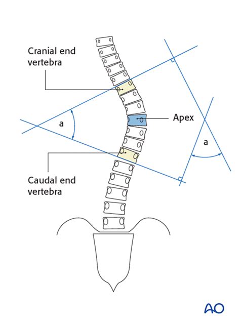 Lenke Classification
