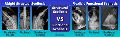Structural Scoliosis Vs Nonstructural Scoliosis Vrogue Co