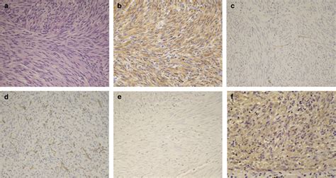Histological And Immunohistochemical Findings In Gist A B A Gist