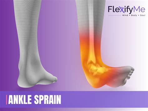 Ankle Sprain Treatmentsymptomsexercises And Recovery