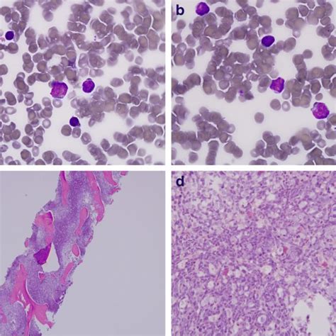 T All Immunophenotype The T Lymphoblasts Are Ccd3 Cd2 Cd7