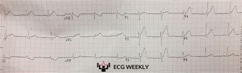 Stemi In A Postpartum Woman A Case Against Risk Factor Bias Ecg Weekly
