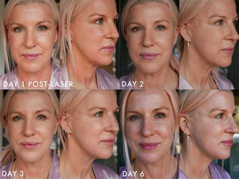Renée Moxi Laser Treatment Experience Before After And Tips Beauty