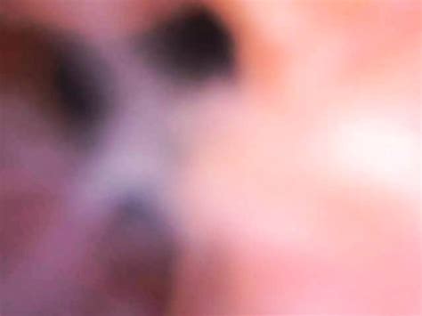 Look Inside Bladder And Prostate With Endoscope Japanese Gay Asian