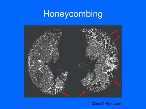Ppt Chest Radiology Plain Film And Ct Beyond The Basics Powerpoint Presentation Id 4761916