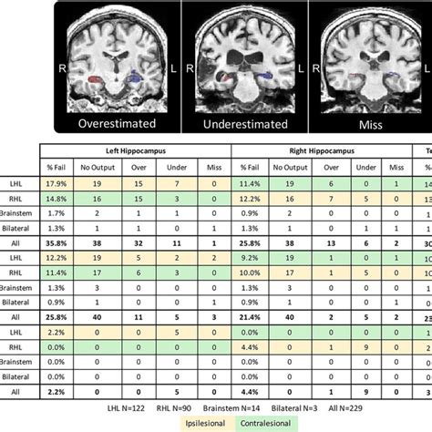 Hippocampal Segmentations Produced By Automated Segmentation Methods Download Scientific
