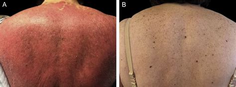 Erythrodermic Psoriasis Treatment With Guselkumab Report Of Two Cases