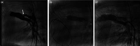 Angiograms Of A Restrictive Pda With Stent Placement A Angiogram Download Scientific