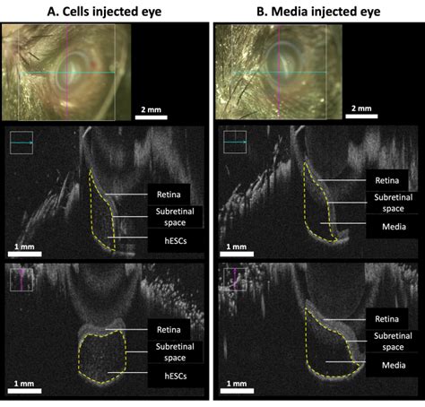 Sub Retinal Delivery Of Human Embryonic Stem Cell Derived Photoreceptor Progenitors In Rd10 Mice