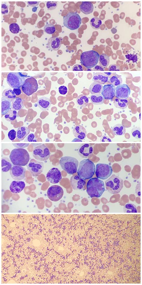 The Aml From Yesterday With 12 Blasts R Medlabprofessionals