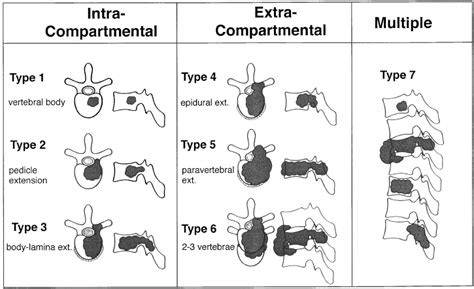 Schematic Diagram Of Surgical Classification Of Spinal Tumors