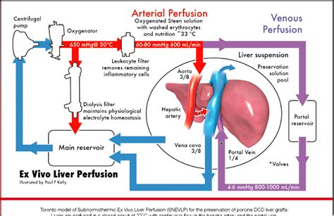 Figure 1 From Ex Vivo Liver Perfusion For Organ Preservation Recent Advances In The Field