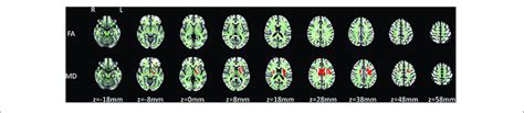 Tract Based Spatial Statistics Tbss Analysis Of Asymptomatic