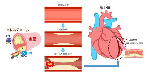 脂質異常症 にしむら内科クリニック浦和の内科消化器内科内視鏡クリニックです