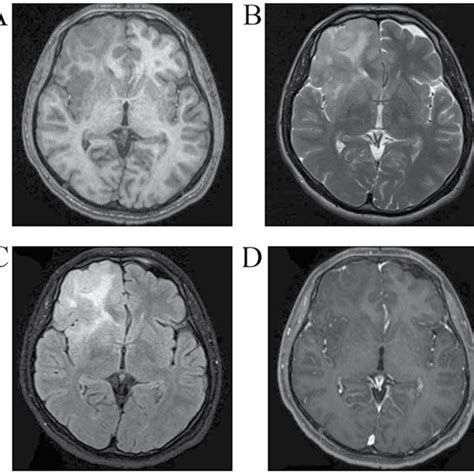 Case 2 Axial Brain Mri Indicating A Lesion In The Right Frontal Lobe
