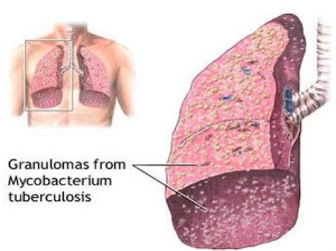 Simptomi I Klinicki Formi Na Tuberkuloza Ppt