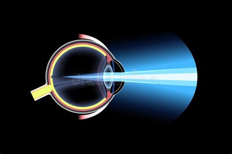 Short Sightedness Refractive Error Stock Illustrations 44 Short Sightedness Refractive Error