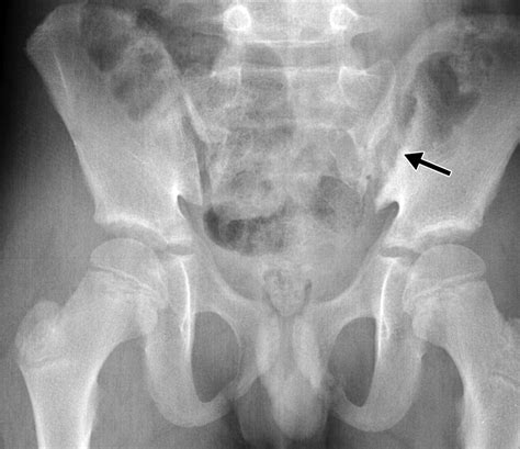 Imaging Of Chronic Recurrent Multifocal Osteomyelitis Radiographics