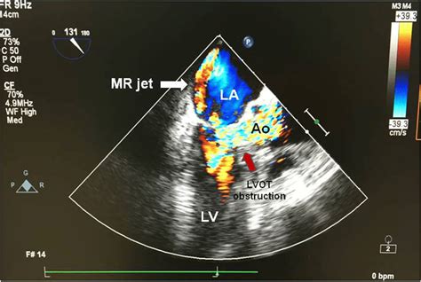 Intraoperative Transesophageal Echocardiography With Color Flow Doppler Download Scientific