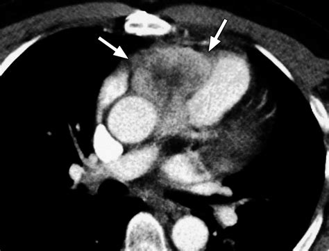 Cross Sectional Imaging Of Paragangliomas Of The Aortic Body And Other Thoracic Branchiomeric