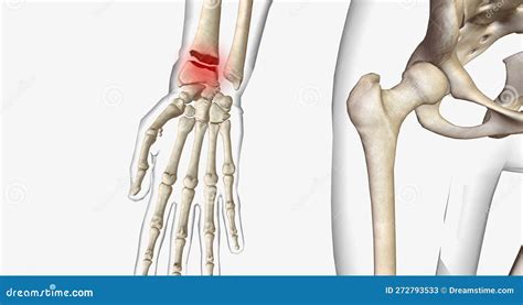 Distal Radius Fractures Are Among The Most Common Types Of Fractures And Are Most Common In The
