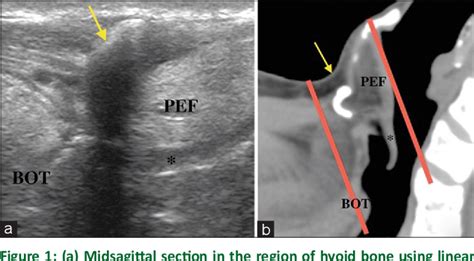 Malignant Pyriform Fossa Neoplasm Semantic Scholar
