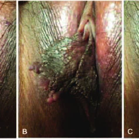 A The Appearance Of Postoperative Bilateral Labia Minora 24 Hours Download Scientific