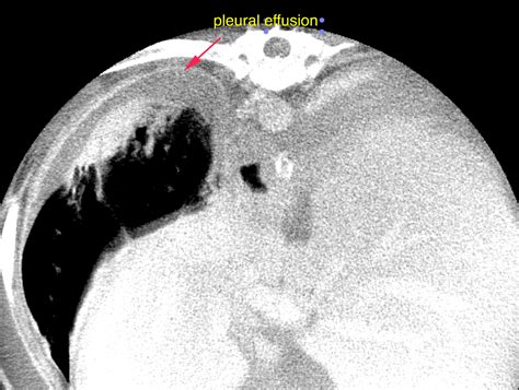 Ct Recurrent Pyothorax With Lymphadenitis In A 7 Year Old F Beagle Members