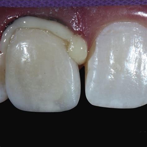Pdf Anterior Composite Resin Crown In An Adverse Situation A Dental